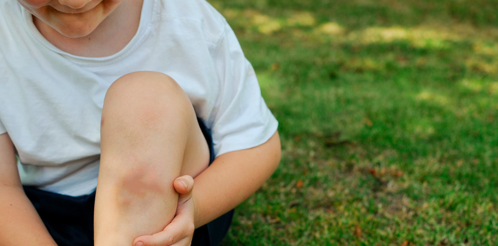 ¿Puede haber moratones sin golpe?