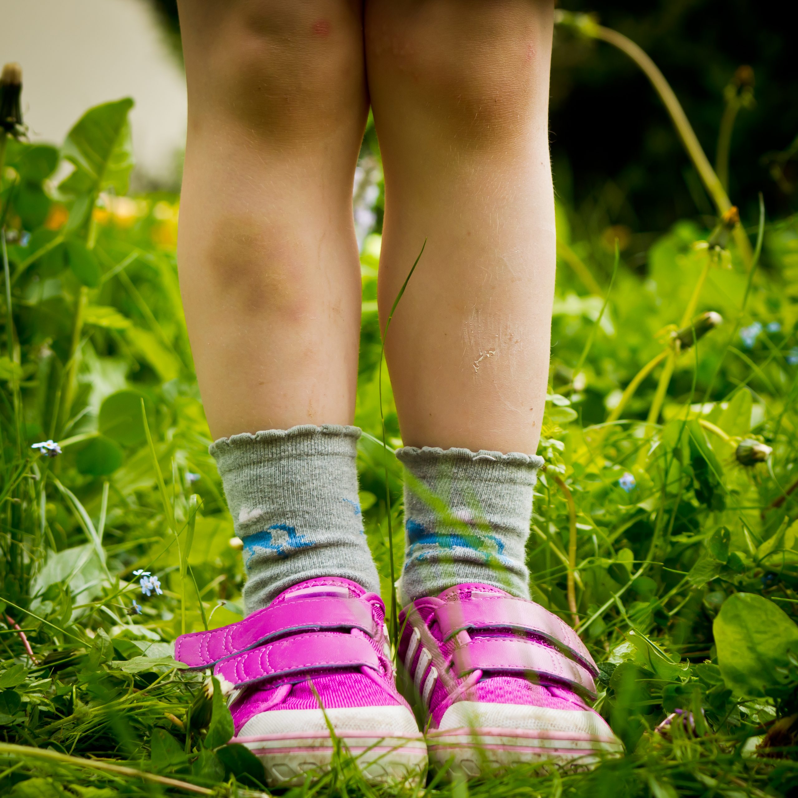 ¿Por qué se producen tantos moratones en la piel de los niños?
